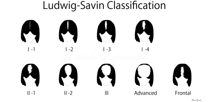 Ludwig-Savin分類 (女性型脱毛症) - 医学ブログ